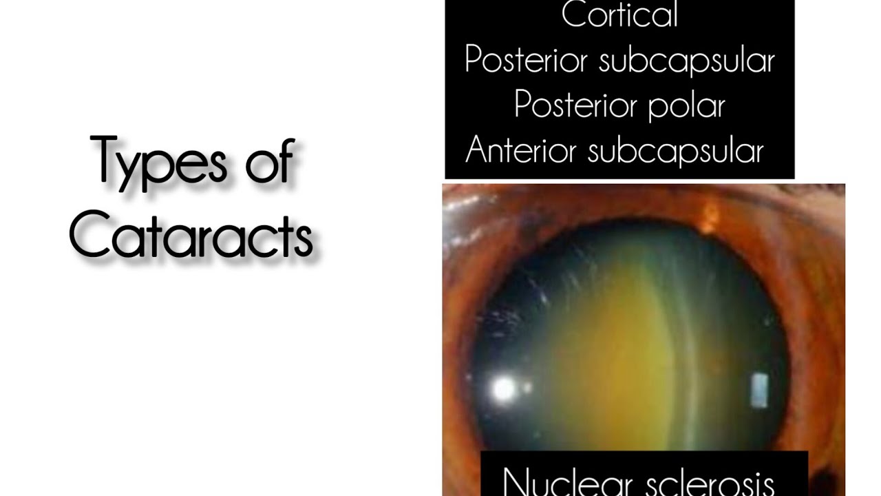 Types of Cataracts - YouTube
