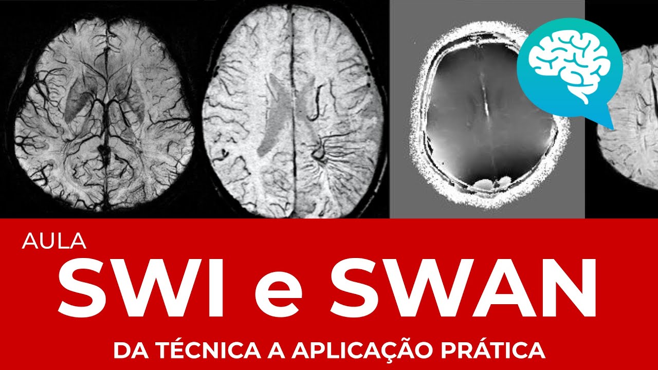 SWI SWAN DA TÉCNICA A APLICAÇÃO PRÁTICA | AULA - Dr Marcio Almeida ...