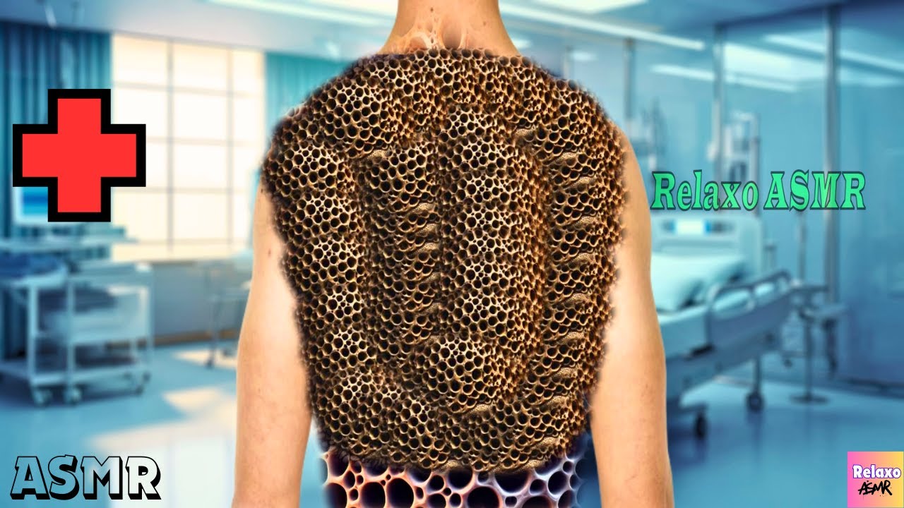 HEAVY INFECTED BACK ASMR TREATMENT | REMOVE TRYPOPHOBIA ANIMATION ...
