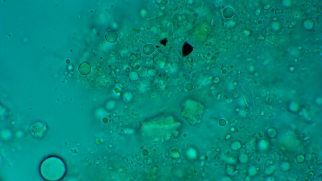 Pediatrics. Stool. Candidiasis. - YouTube