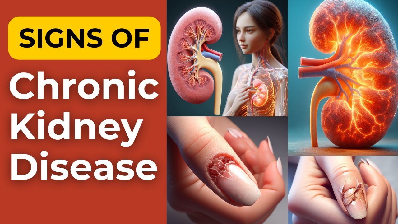 7 Early-Stage Warning Signs of Kidney Trouble (Chronic Kidney Disease ...