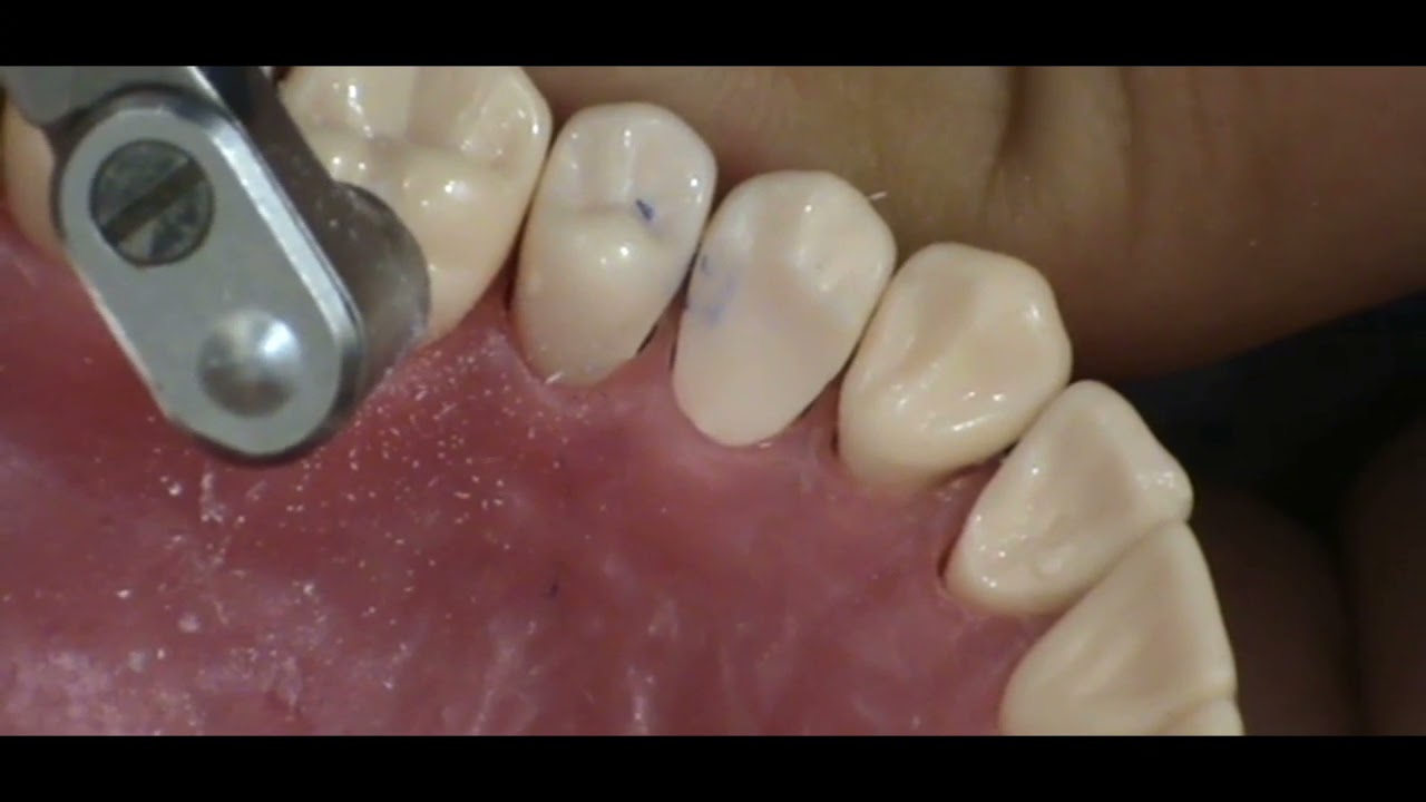 Class I palatal Pit Right Upper First Molar - YouTube