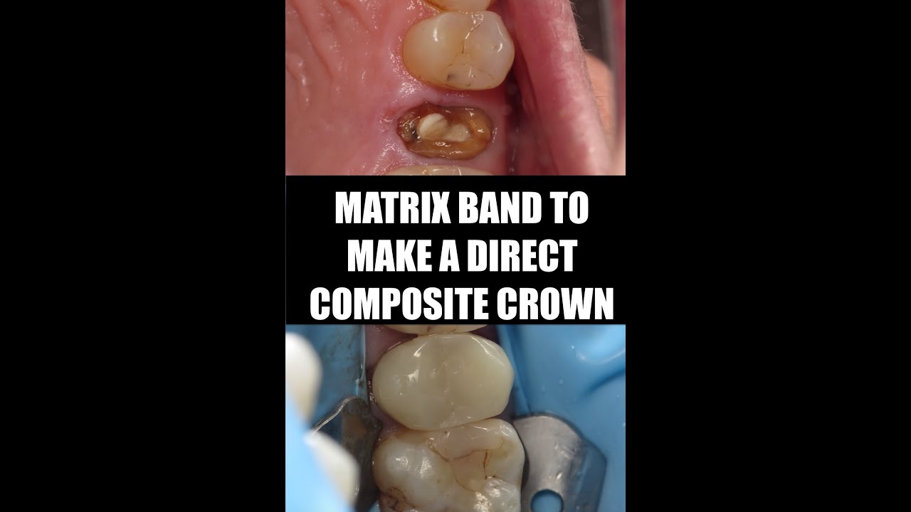 How to make a direct Composite crown with Greater Curve Matrix Band ...