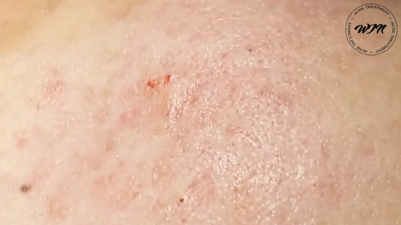 Relax Every Day - Squeeze blackheads - How to Get Rid of Blackheads ...