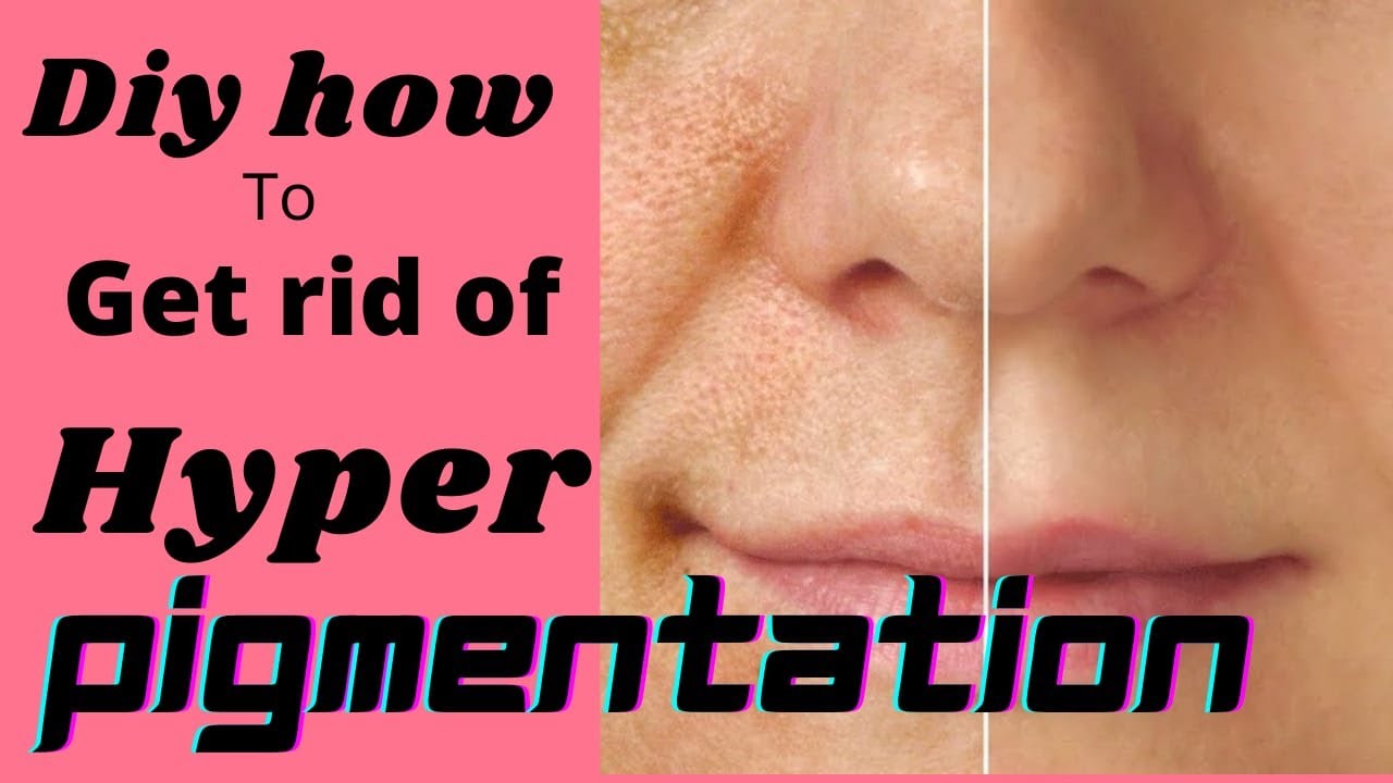 How to Get Rid of Hyperpigmentation । Remove Pigmentation At Home ...