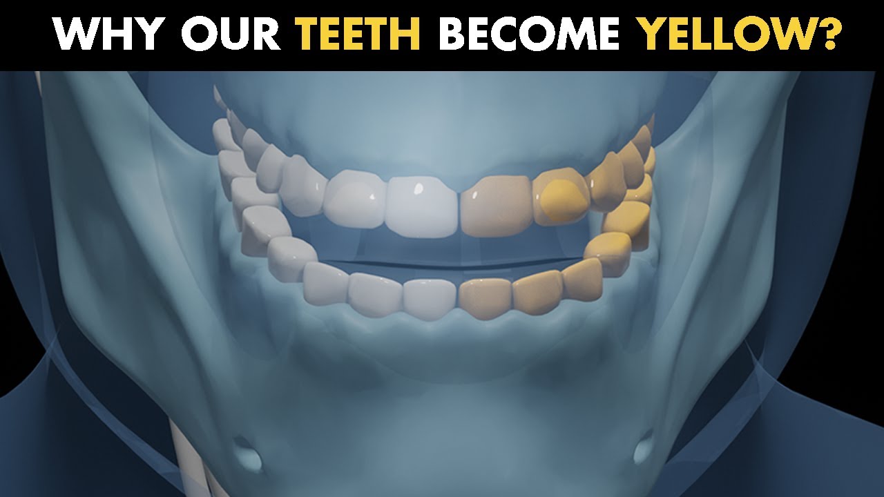Why Our Teeth Become Yellow? (Yellow Teeth) | Teeth yellowness or ...