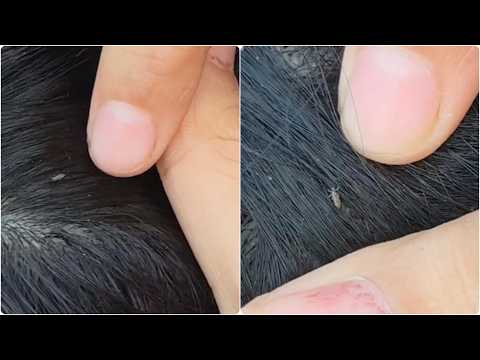 Close scalp view|| picked so much lice