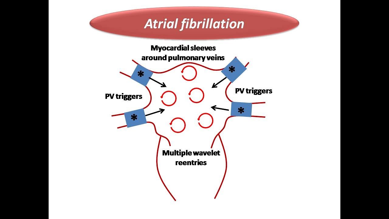 ECG course: Atrial Fibrillation, Dr. Sherif Altoukhy - YouTube