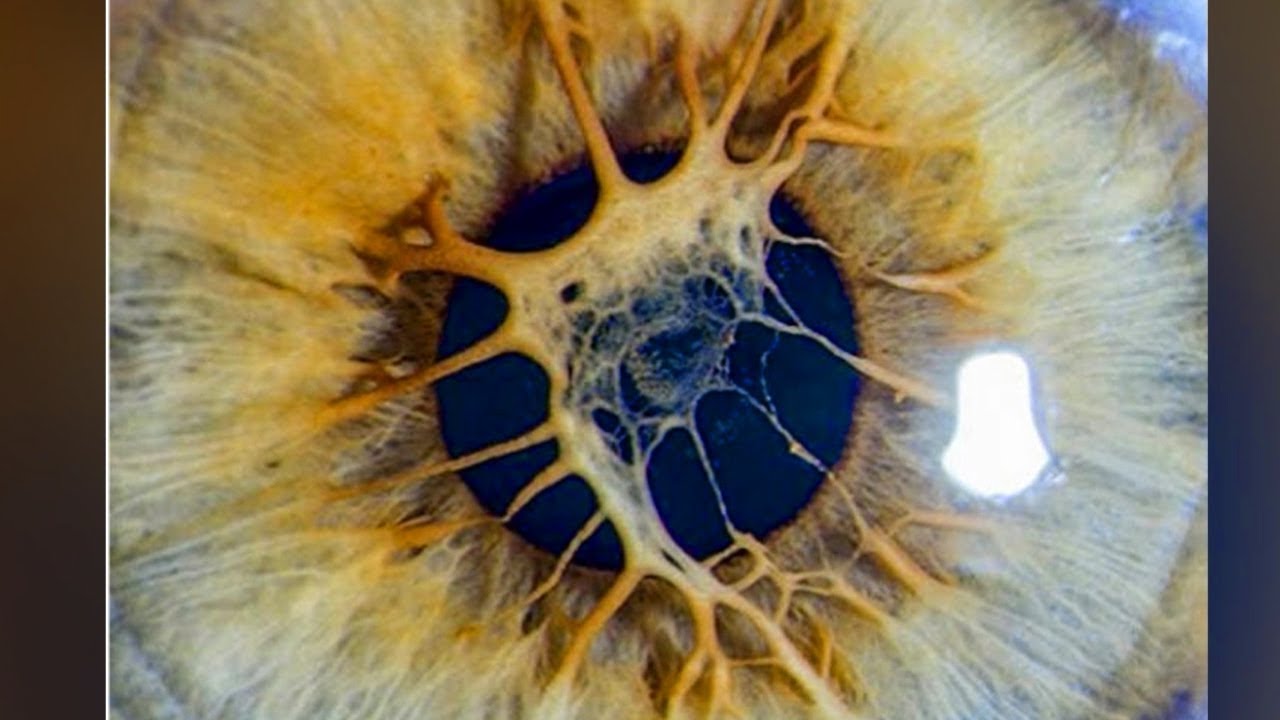 What's Wrong with My Eyes? Persistent Pupillary Membrane (PPM) - YouTube