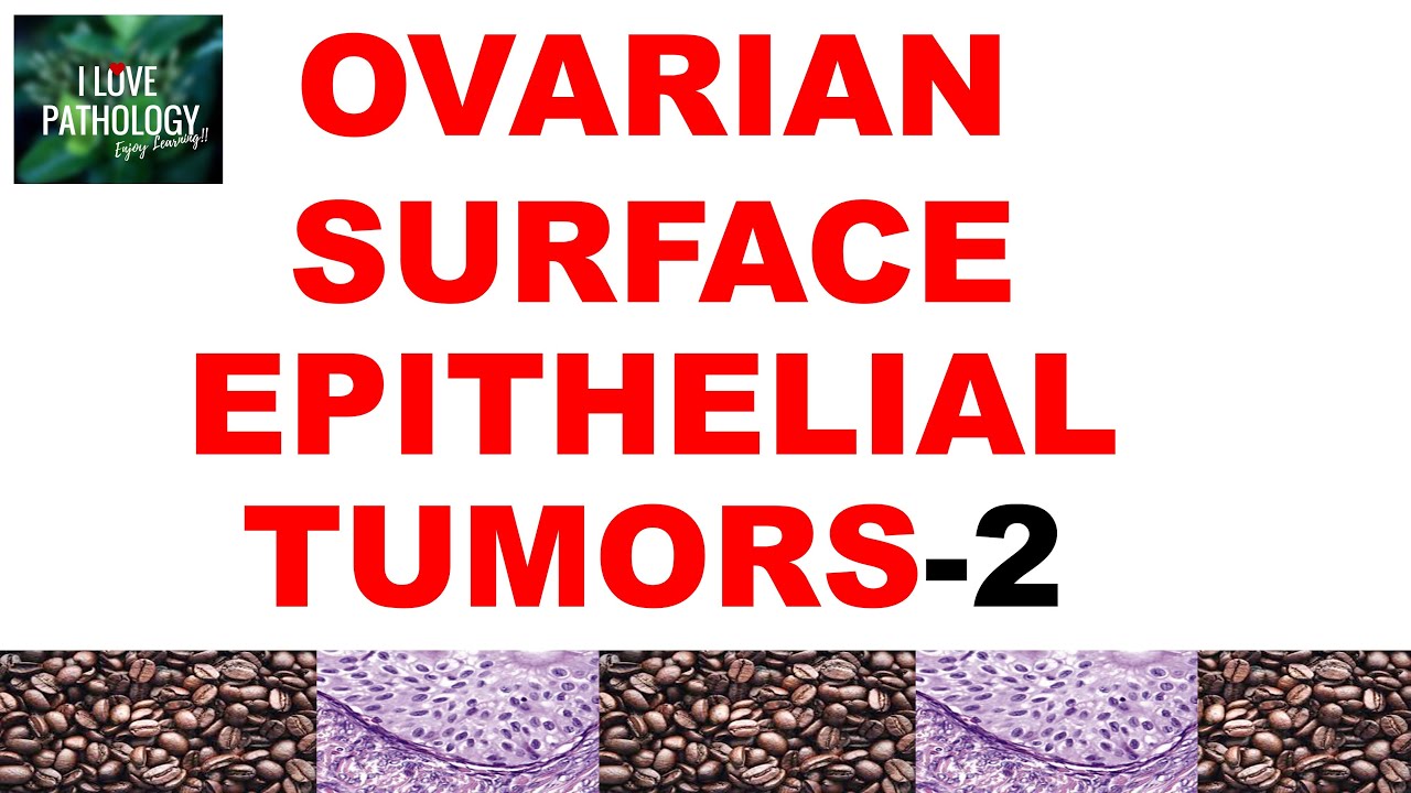 OVARIAN TUMORS - Part 3 : ENDOMETRIOID, CLEAR CELL & BRENNER TUMOR ...