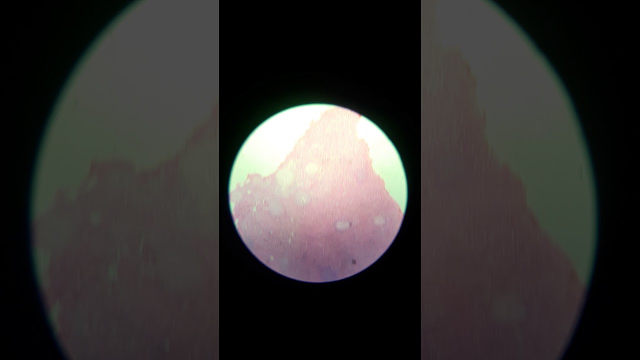 Liver - Bilharzial polyp 31 - YouTube