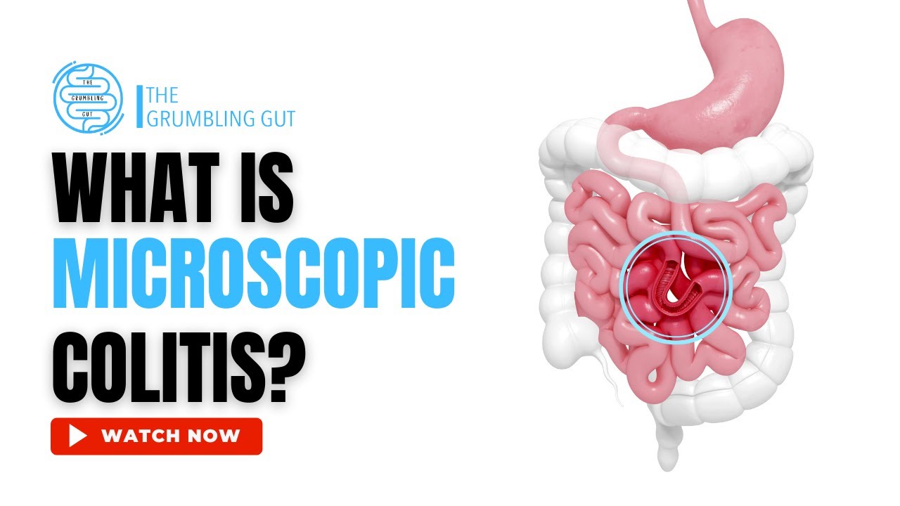 WHAT IS MICROSCOPIC COLITIS I THE OTHER TYPE OF INFLAMMATORY BOWEL ...