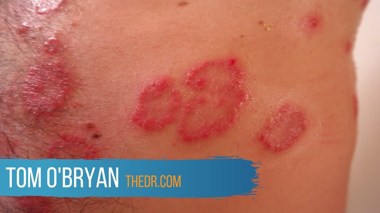Man with Rare Rash goes to 60 Doctors to Find an Effective Treatment ...