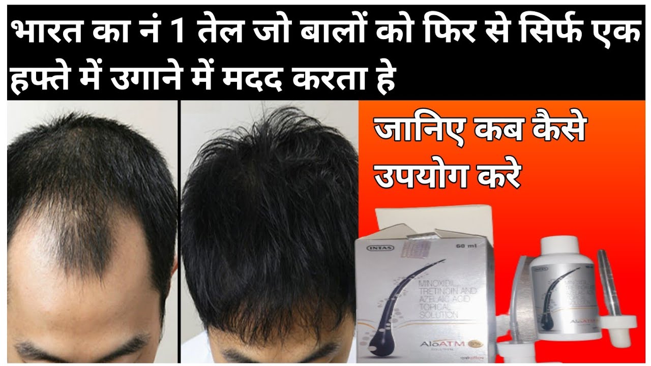 Aloatm 5% Solution || india's No1 hair solution||झड़ते बालों को रोकने ...