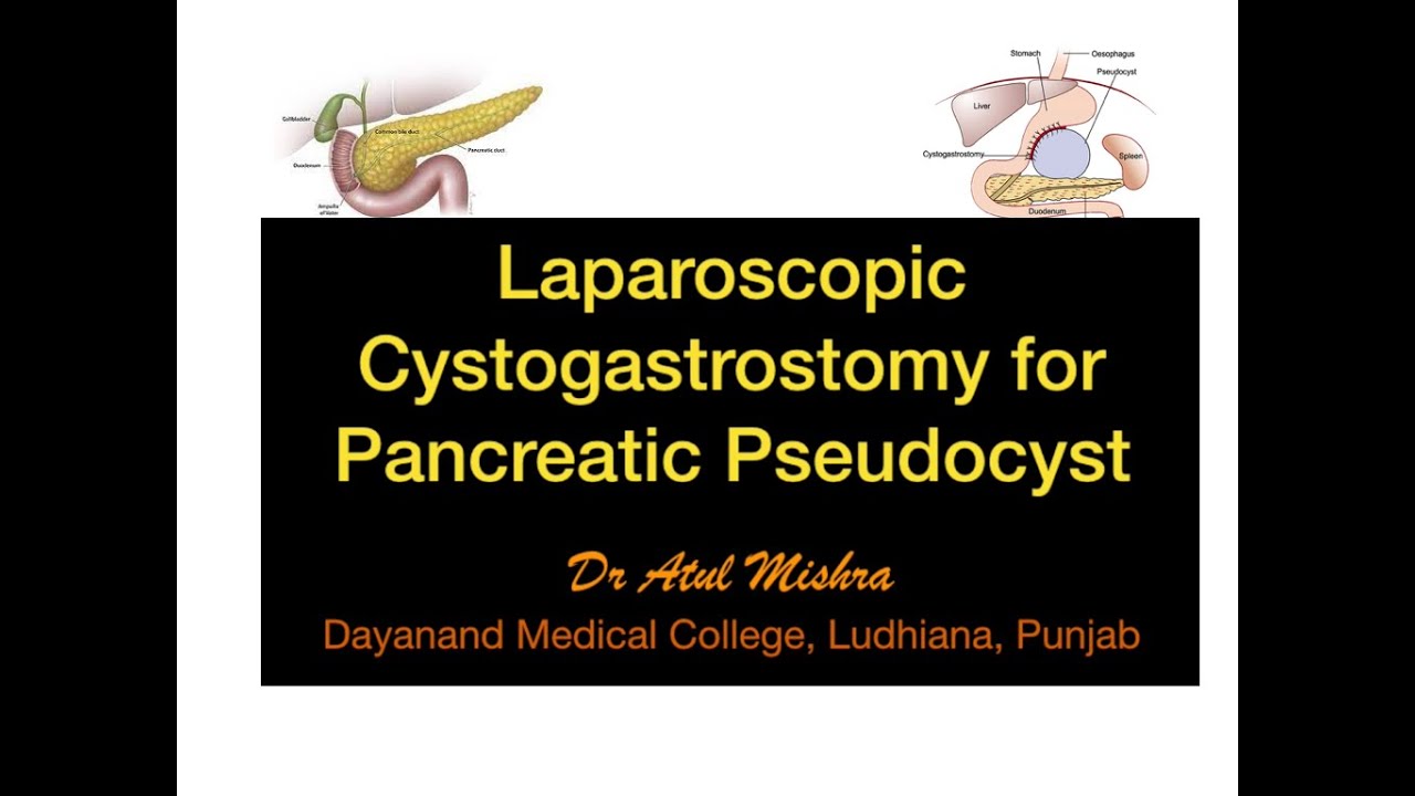 𝐋𝐚𝐩𝐚𝐫𝐨𝐬𝐜𝐨𝐩𝐢𝐜 𝐂𝐲𝐬𝐭𝐨𝐠𝐚𝐬𝐭𝐫𝐨𝐬𝐭𝐨𝐦𝐲 𝐟𝐨𝐫 𝐏𝐚𝐧𝐜𝐫𝐞𝐚𝐭𝐢𝐜 𝐏𝐬𝐞𝐮𝐝𝐨𝐜𝐲𝐬𝐭: 𝐃𝐫 𝐀𝐭𝐮𝐥 𝐌𝐢𝐬𝐡𝐫𝐚 ...