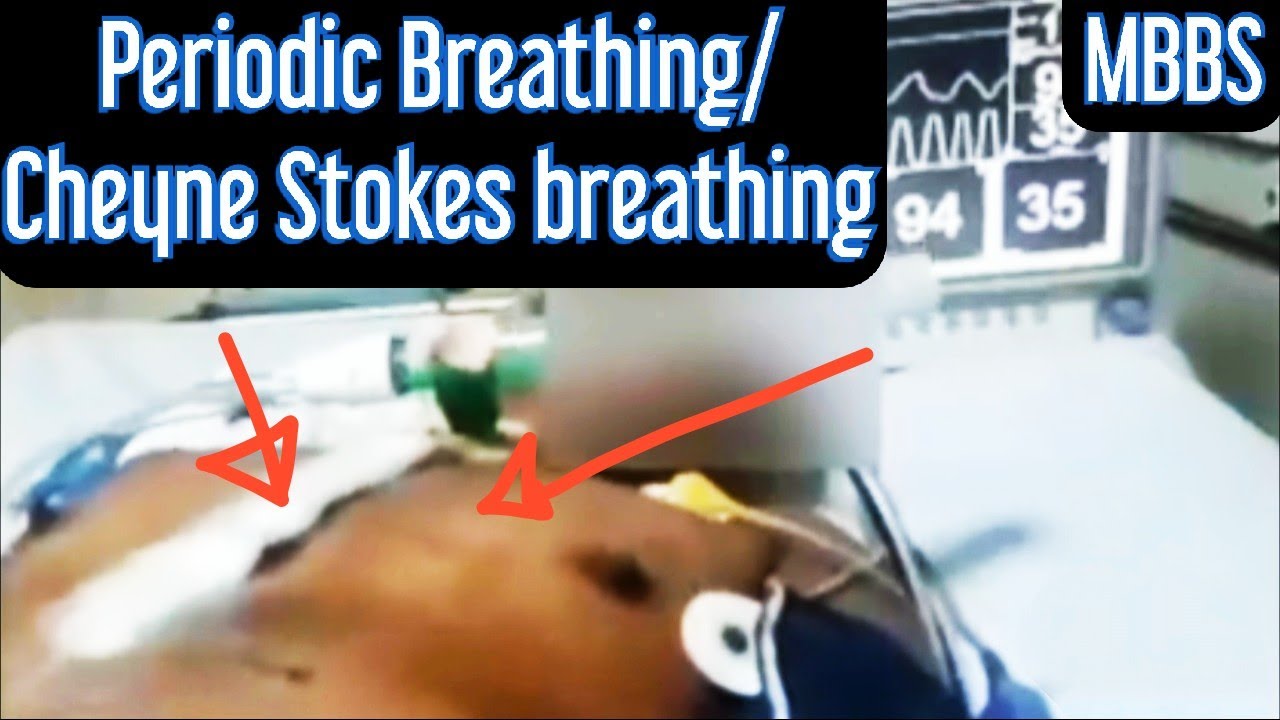 Periodic Breathing/ Cheyne Stokes Breathing. #mbbs #medicine #neetpg # ...