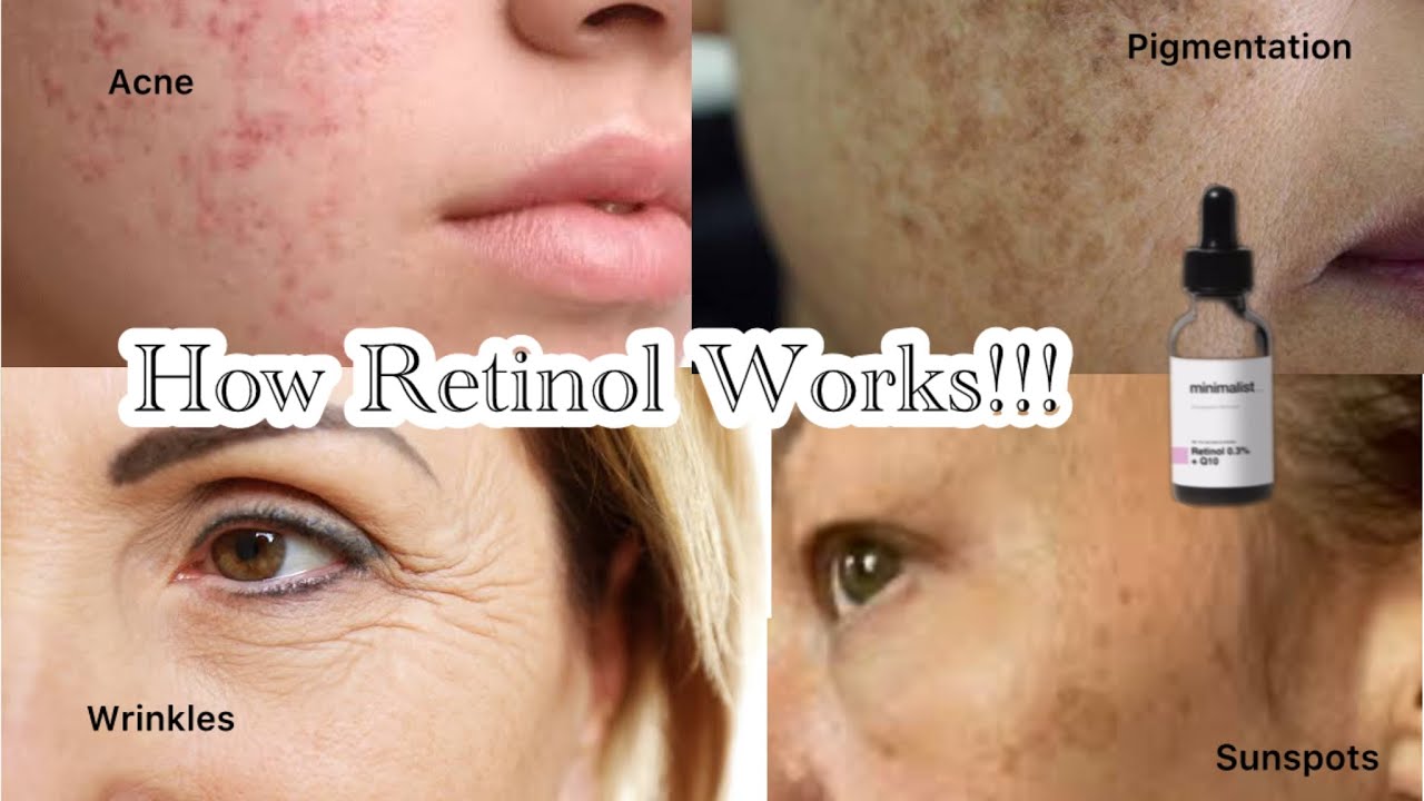 Retinol Explained | Beginners Guide To Retinol | Benefits, How It Works ...