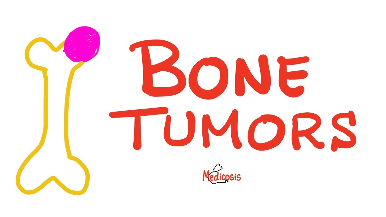 Bone Tumors - Osteosarcoma, Ewing Sarcoma, Giant Cell Tumor ...