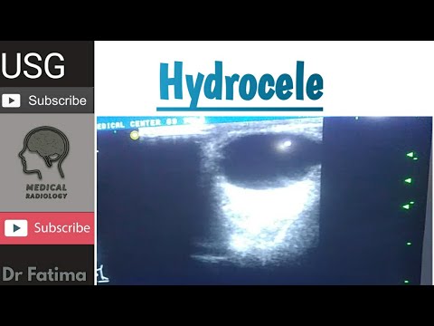 spermatic cord hydrocele by Dr.fatima - YouTube