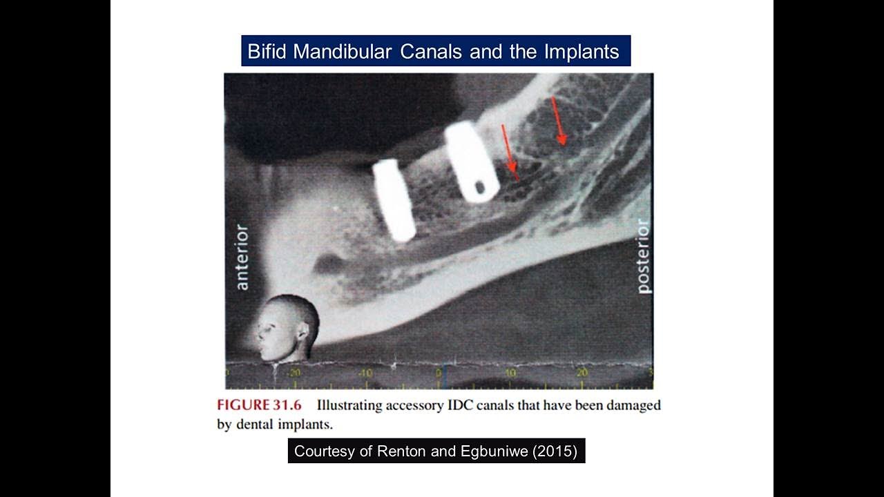 Bifid and Trifid Mandibular Canal (Innervation of Teeth: Recent and Old ...