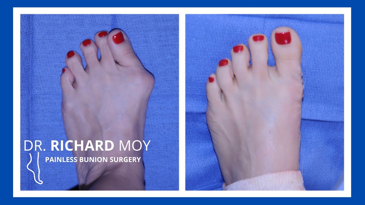 PAINLESS BUNION PROCEDURE! (no lapiplasty needed) #footsurgery # ...