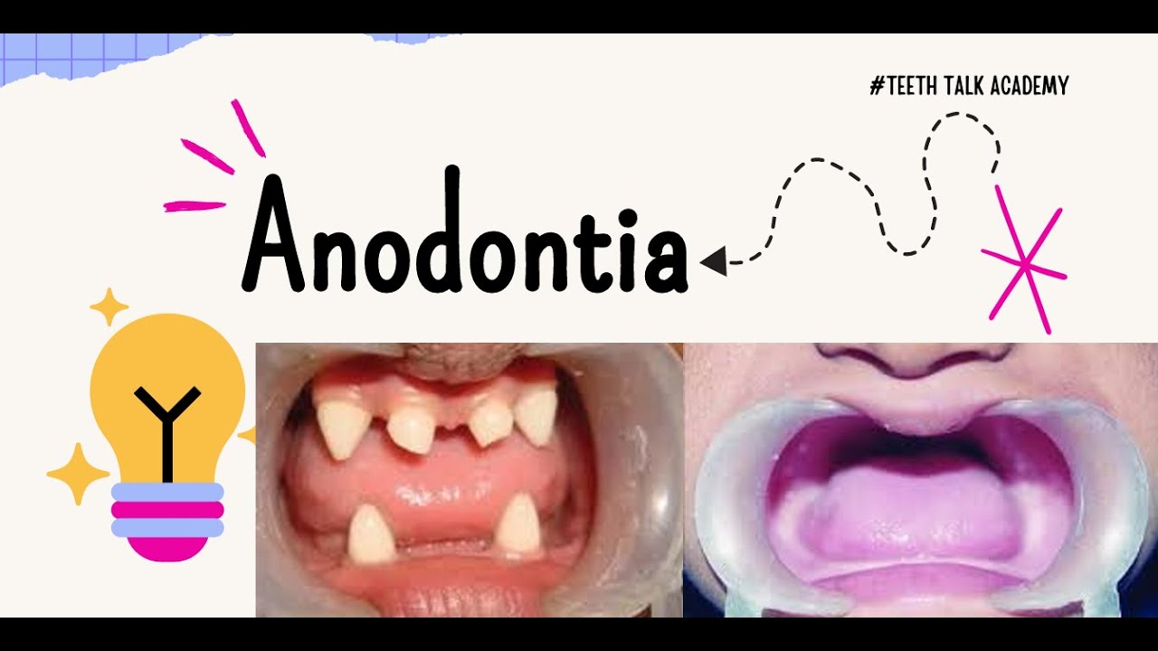 ANODONTIA | DEVELOPMENTAL DISTURBANCE OF NO OF TEETH | BDS | MDS | ORAL ...