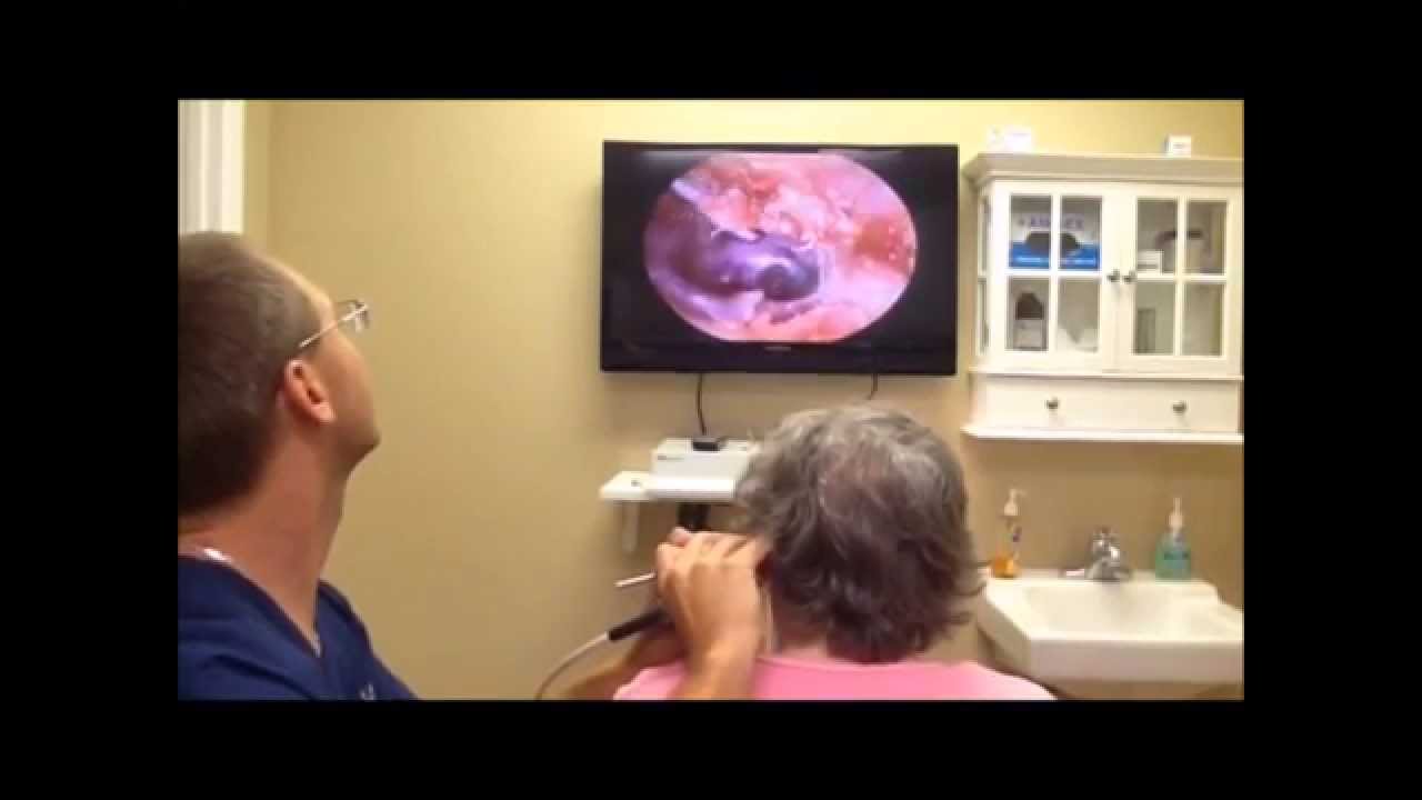 Demonstration of Audiologist removing ear wax to help hearing aid ...