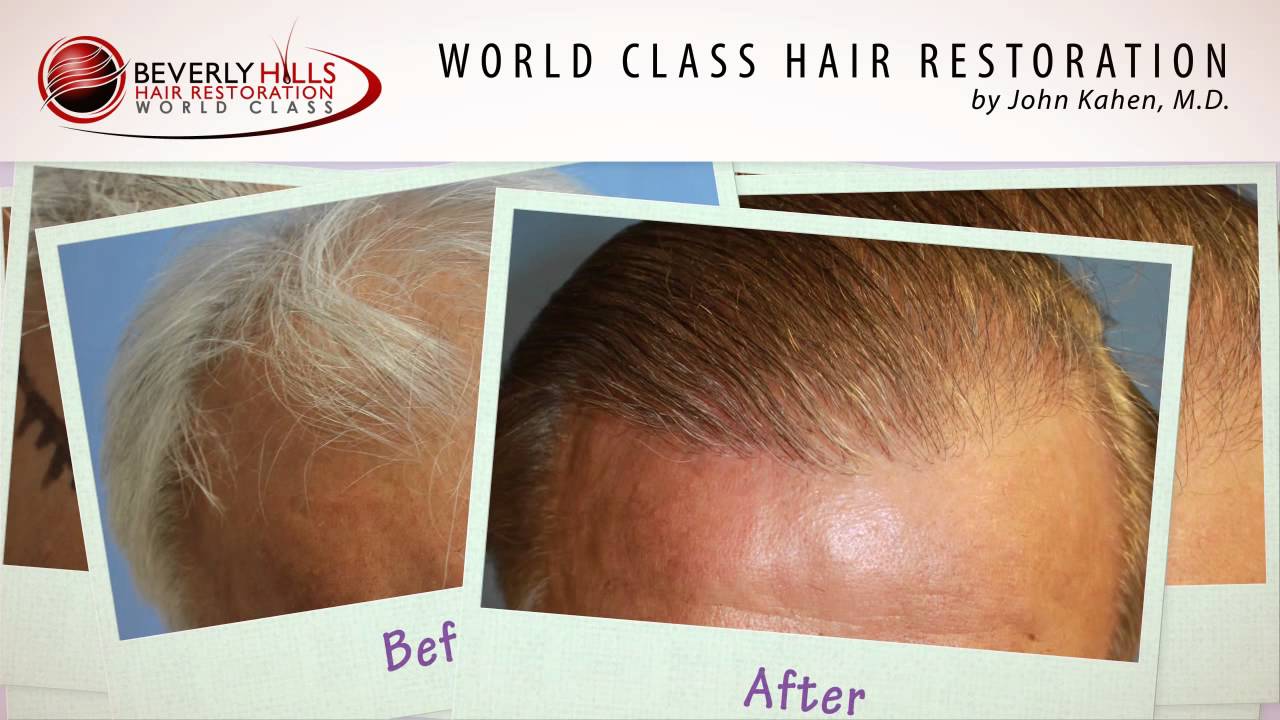 Male Pattern Baldness Hair Restoration Surgery Solution By John Kahen ...