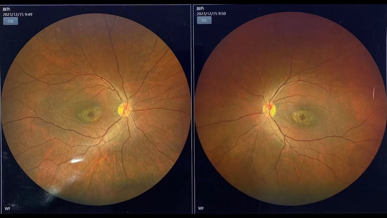 Stabilization and Improvement in Vision - A Success Story with AC STIM ...