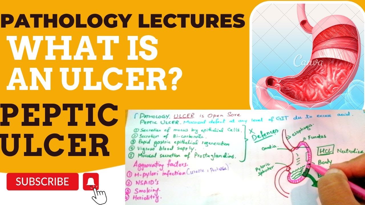 Peptic Ulcer Disease | Pathology | Pathophysiology | Part 1 - YouTube