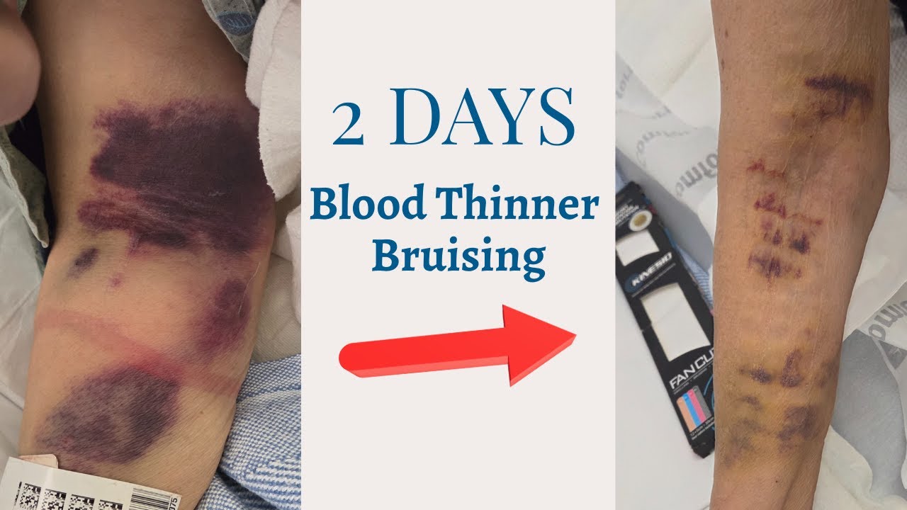 How I Reduced My Mom's Blood Thinner Bruising in 2 Days (Hospital ...