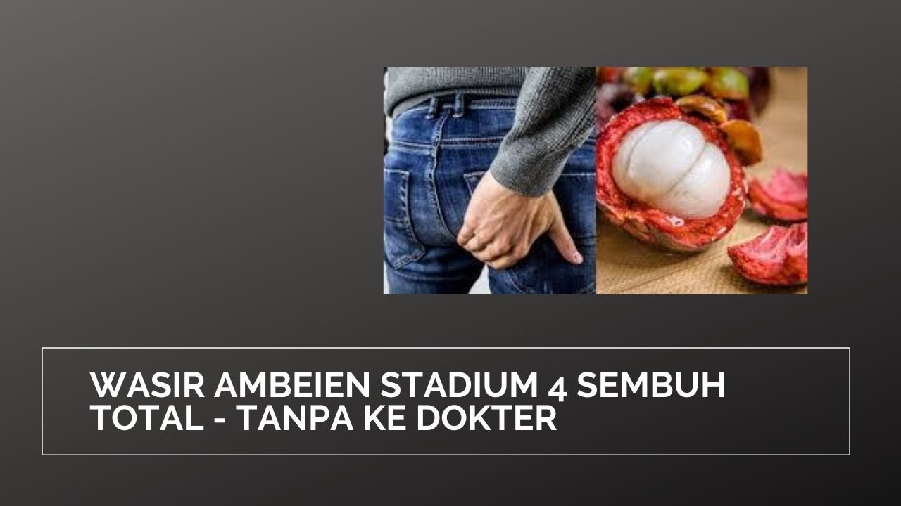 WASIR AMBEIEN STADIUM 4 SEMBUH TOTAL - Tanpa Ke Dokter - YouTube