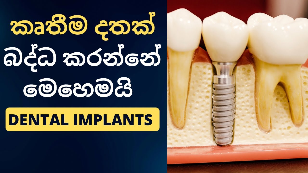 Dental Implants in Sinhala | ස්ථිර දතක් හිටවන විදිය | දත් බද්ද කිරීම ...