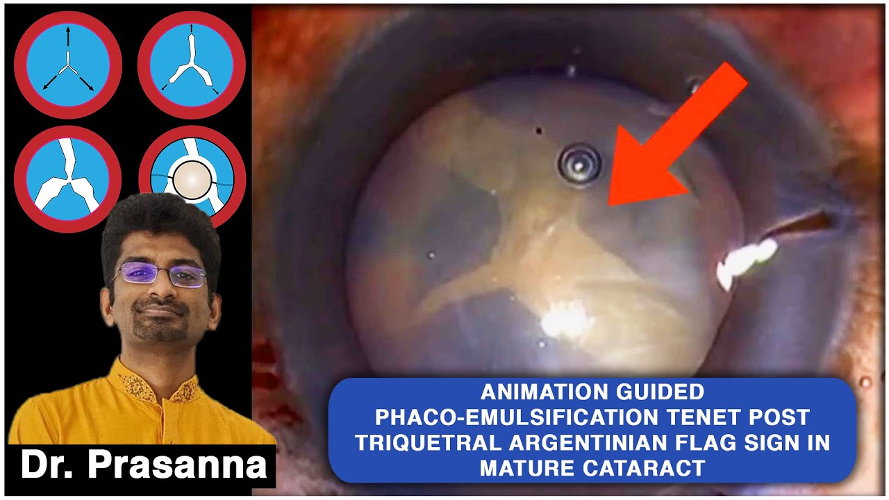 Animation Guided Phaco-Emulsification Tenet Post Triquetral Argentinian ...
