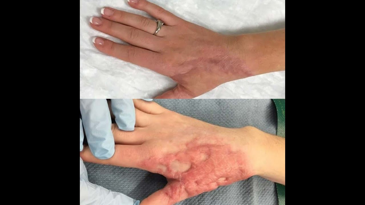 Burn Scar Combination Treatment | Old Burn Scars | Best Scar Treatment ...