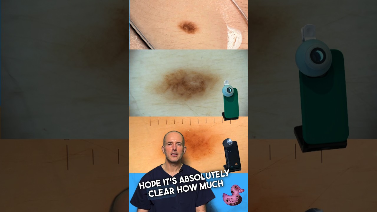See the Difference: Comparing 3 Different Dermatoscopes for Early Skin ...