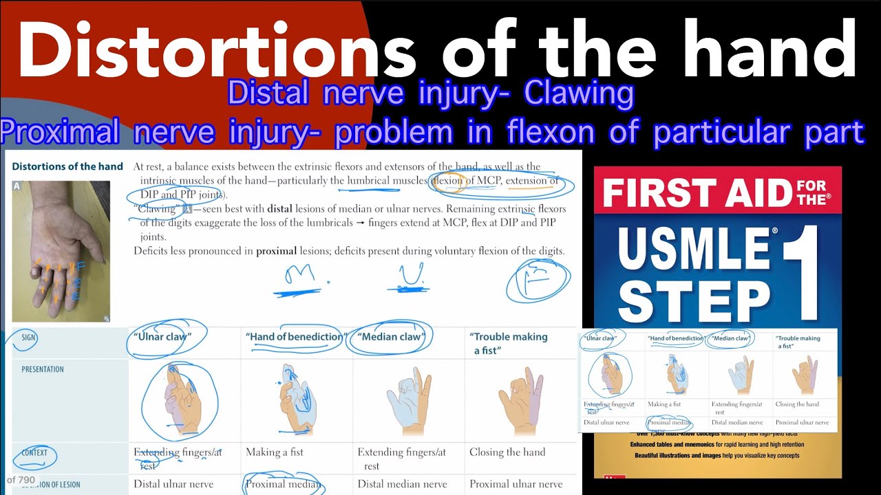 Distortions of the hand- Ulnar claw, Medial claw, Hand of benediction ...