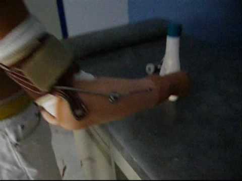 PROTESIS TRANSRADIAL MANO MECÁNICA - TRANSRADIAL PROSTHETIC - YouTube