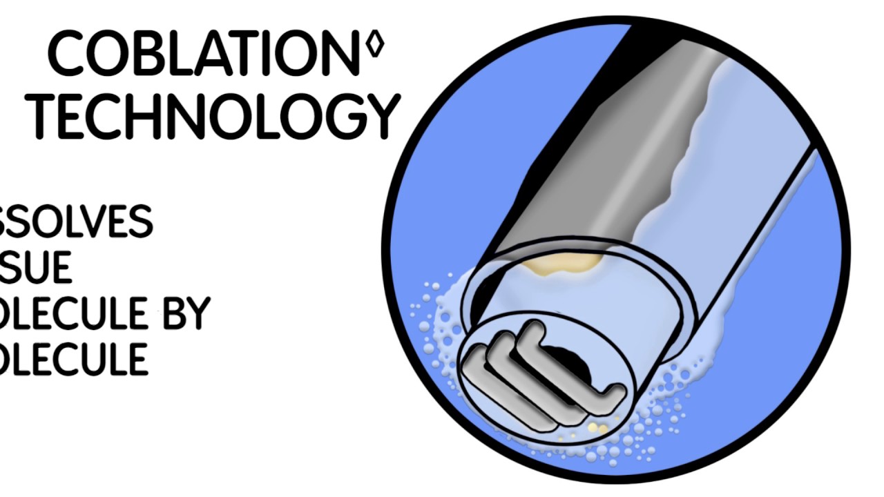 COBLATION Tonsillectomy - YouTube