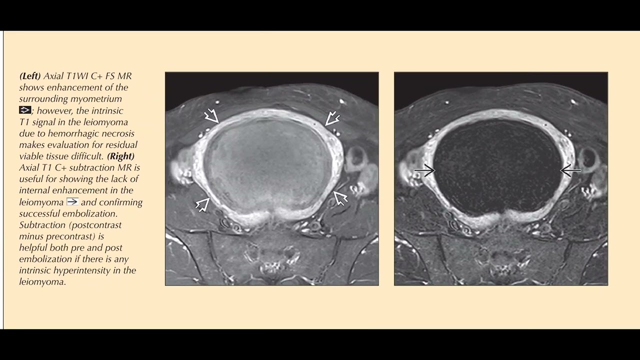 Gynae imaging Diagnostic imaging series (3) - YouTube