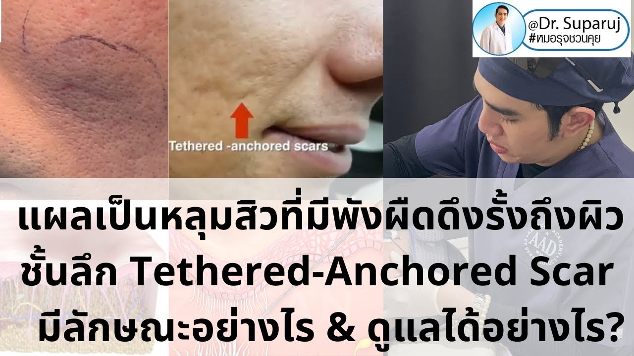 แผลเป็นหลุมสิวที่มีพังผืดดึงรั้งถึงผิวชั้นลึก Tethered-Anchored Scar ...