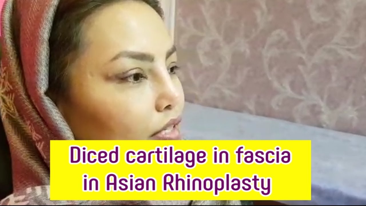 Diced cartilage in fascia in Asian Rhinoplasty | Dr Amir Sajadian - YouTube