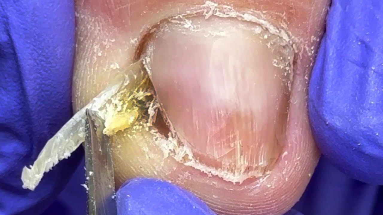 Early Onychomycosis Timely Treatment To Avoid Infection Pedicure