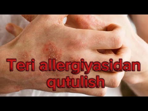 Тери аллергиясидан қандай қутулиш мумкин? Табиий даволаш