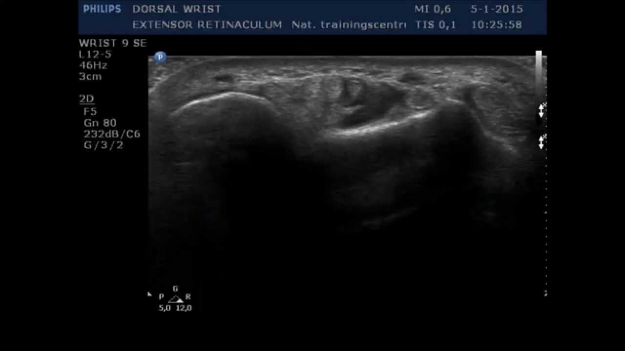 Ultrasound of the wrist - 4th compartment - YouTube