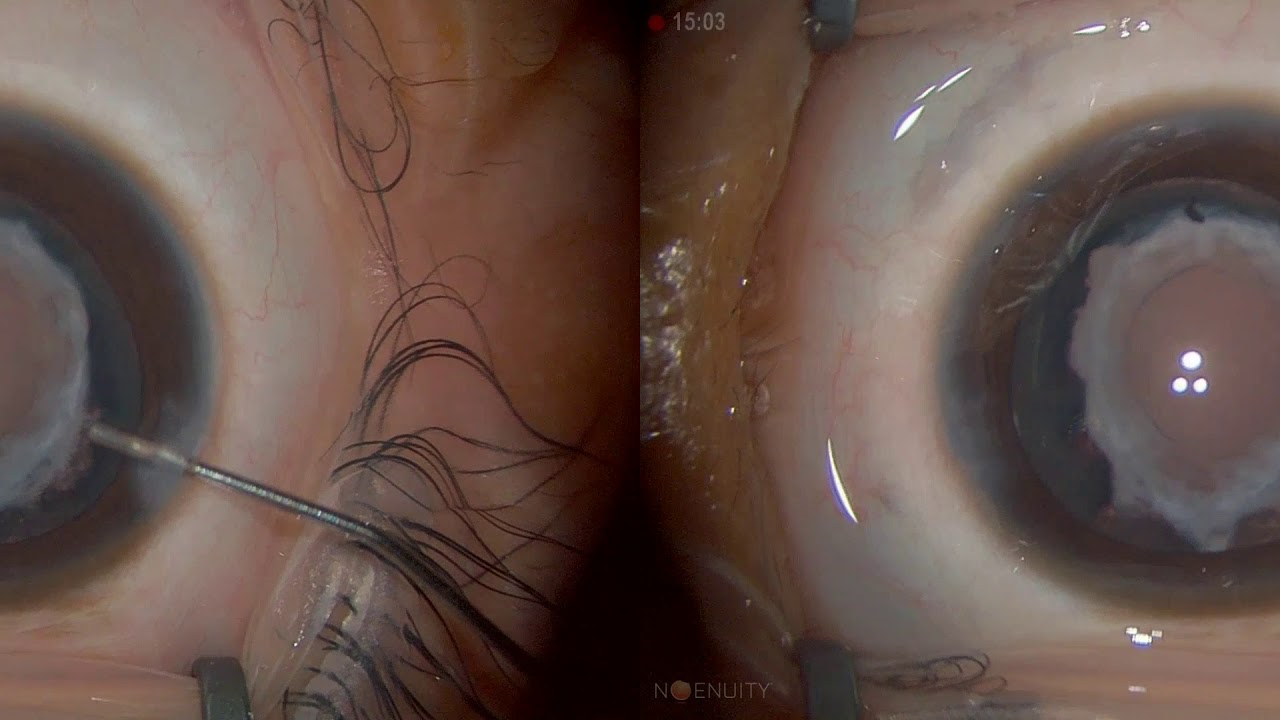 3D Surgery: Secondary Sulcus Fixated IOL Implantation - YouTube