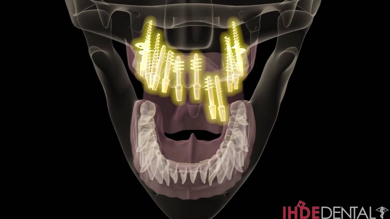 Dental implant surgery, Immediate loading of dental implants, Basal ...