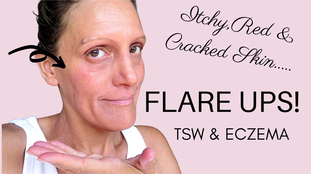HOW TO MANAGE A FLARE UP! FOR ECZEMA & TSW - YouTube