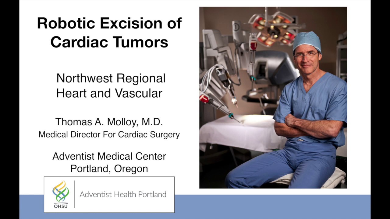Cardiac Tumor Excision - Thomas A. Molloy, MD - YouTube