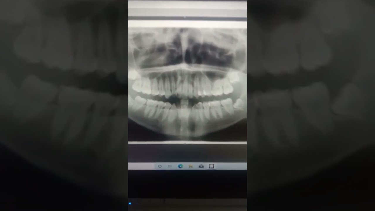 PANORAMIC XRAY COPY - YouTube